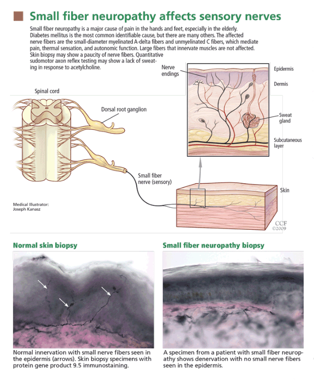 GenÉticaMente InCoRrecta: Posible relación entre el SED y la Neuropatía ...