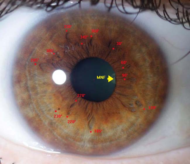 Modern & Multidimensional Iridology: The Combination of Iris Signs in ...