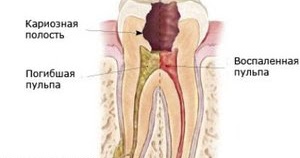 Если появился флюс