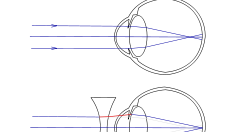 Penyakit Rabun Jauh Miopi Penyebab, Gejala dan Perawatan | Lintas Penyakit