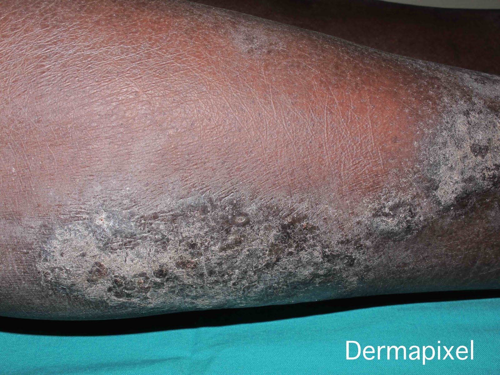 Dermapixel: Escamas y picores