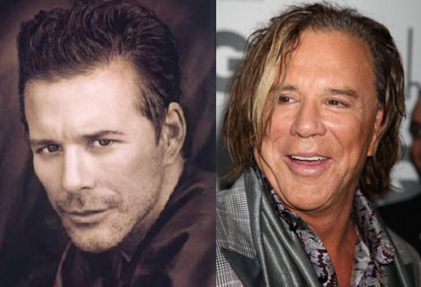 Mickey Rourke Plastic Surgery