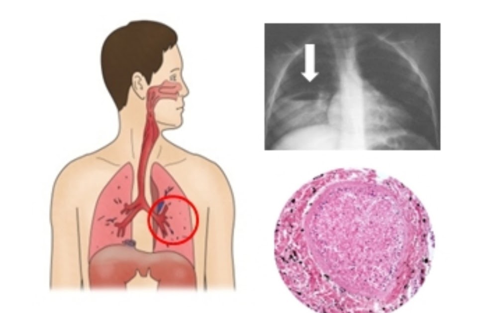 Abses Paru: Penyebab, Gejala, Diagnosa, Pengobatan, Resiko, Pencegahan ...