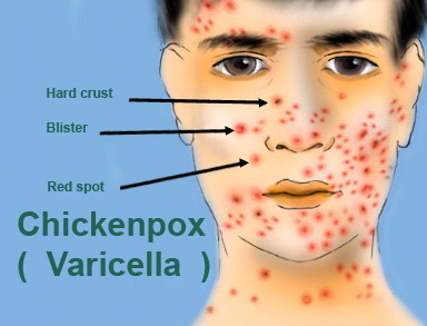 Pharma show : Every thing you want to know about Chickenpox (Varicella)