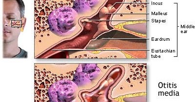 Obat Radang Telinga | Obat Penyakit Tipes