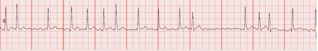 ECG Rhythm Strip Quiz 63
