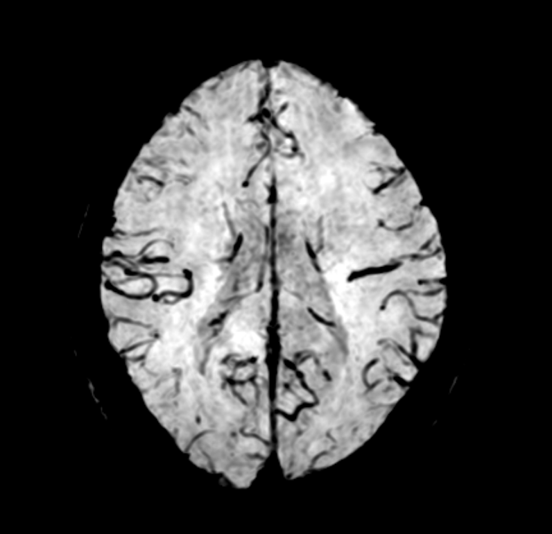 Choroid Plexus Xantogranulomata-MRI - Sumer's Radiology Blog