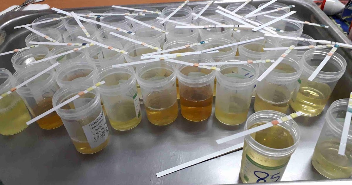 Medicine Newbie: Urine FEME