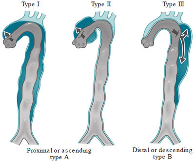 Acute Type A Aortic Dissection Case File