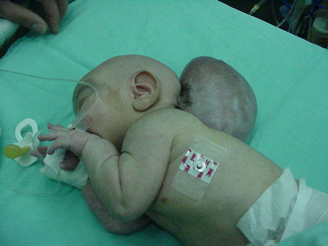 katerin gomez: ENCEFALOCELE