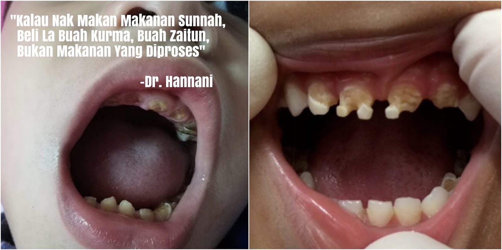 Gambar Gigi Rosak Teruk | teruktizen