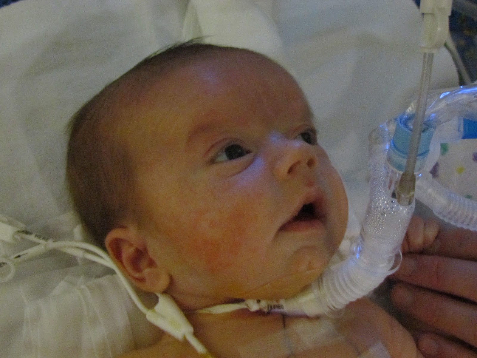 Breathing for Baby Clay: Our CDH Story: Happy Trach Day, Baby Clay!