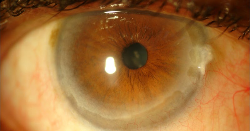 Bệnh thoái hóa cận biên Terrien’s - Terrien’s Marginal Degeneration ...