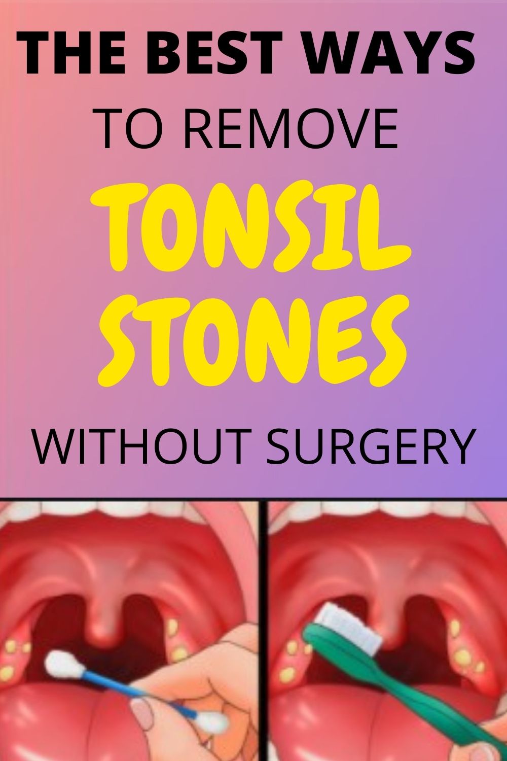 Tonsil Stones Removal Gag Reflex at James Daulton blog