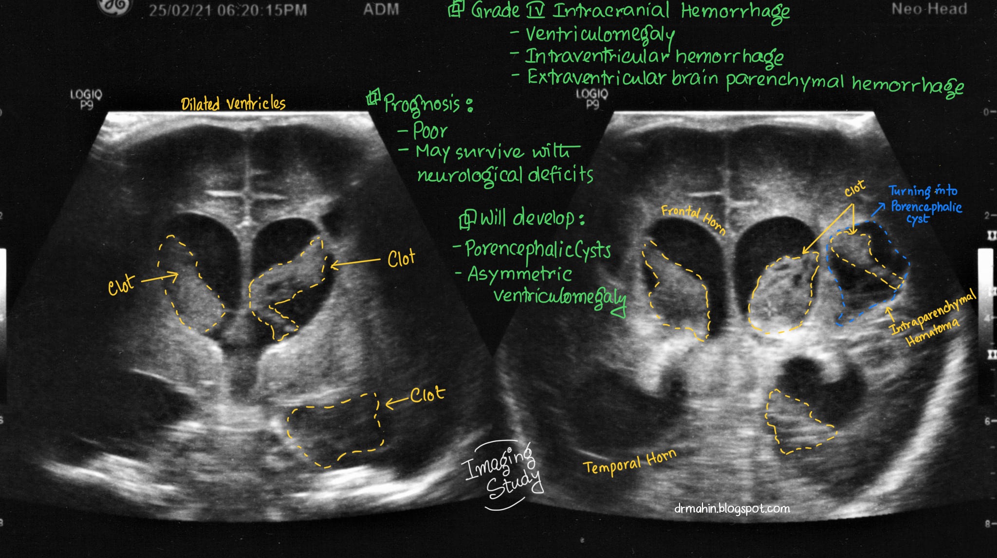 Case 32: Grade IV Intracranial Hemorrhage ~ Imaging Study