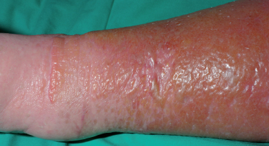 L'érysipèle | Récap' IDE