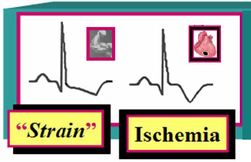 Me You n our similarity,.: Left Ventricular Hypertrophy (LVH), LV ...