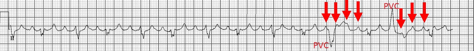 ECG Channel: Atrial Flutter