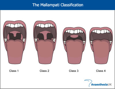 MedicoNotebook: Mallampati classification