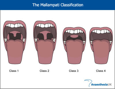 MedicoNotebook: Mallampati classification