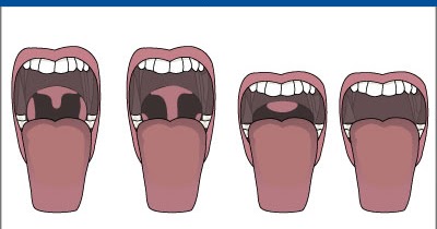 MedicoNotebook: Mallampati classification