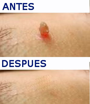 MEDIBELL Medicina y Estética: Eliminar condilomas o verrugas genitales ...