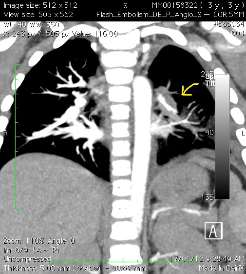 Pulmonary Embolism-CTPA - Sumer's Radiology Blog