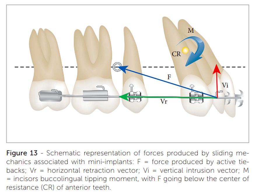 PDF: CLASS I MALOCCLUSION with severe double rotrusion treated with ...