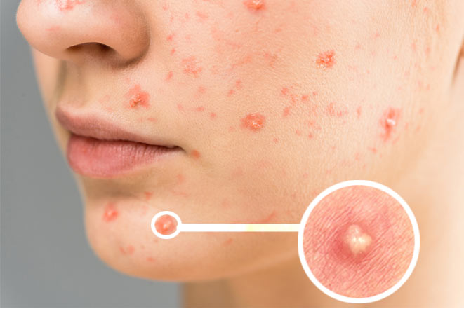 Treatment of Pimples & Acne Marks