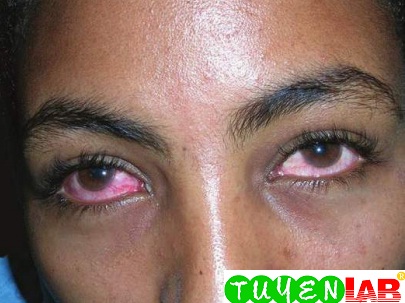 [Pediatric] Atlas of Conjunctivitis | Free Medical Atlas