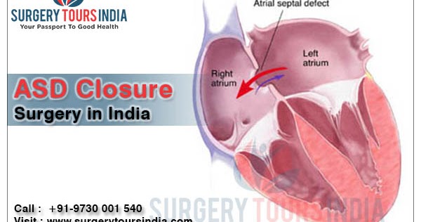 ASD Closure Surgery in India: Surgeries and Devices Used For Treatment ...