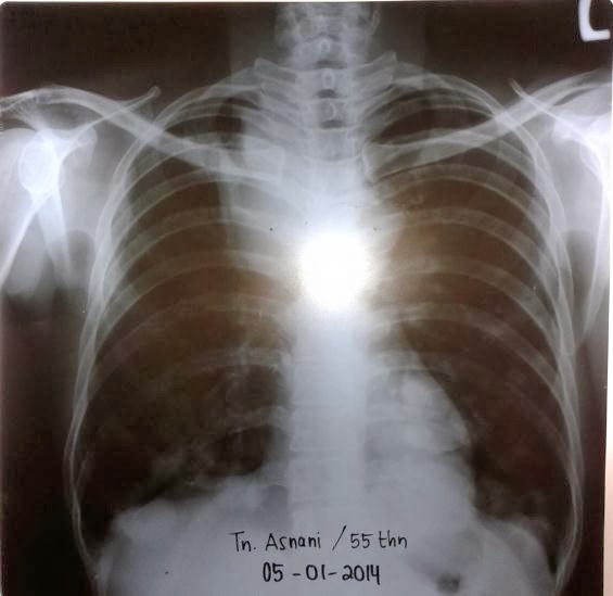 Belajar Membaca Foto Thorax - breadelectro