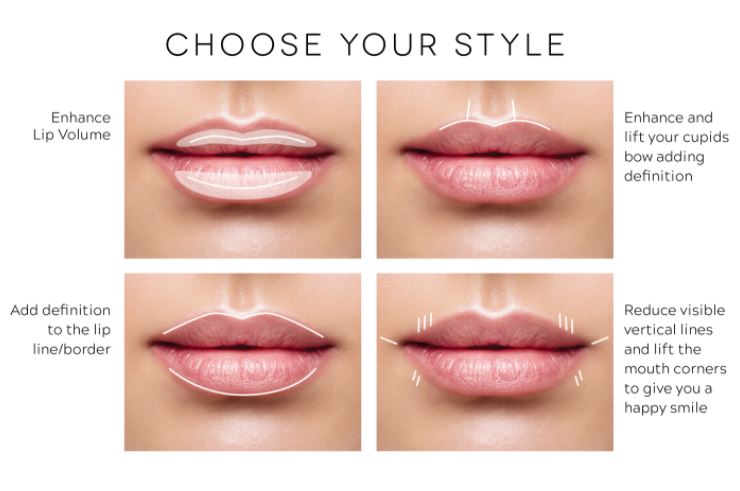 Rhonda's Escape: Lip Shape and Size - Fillers