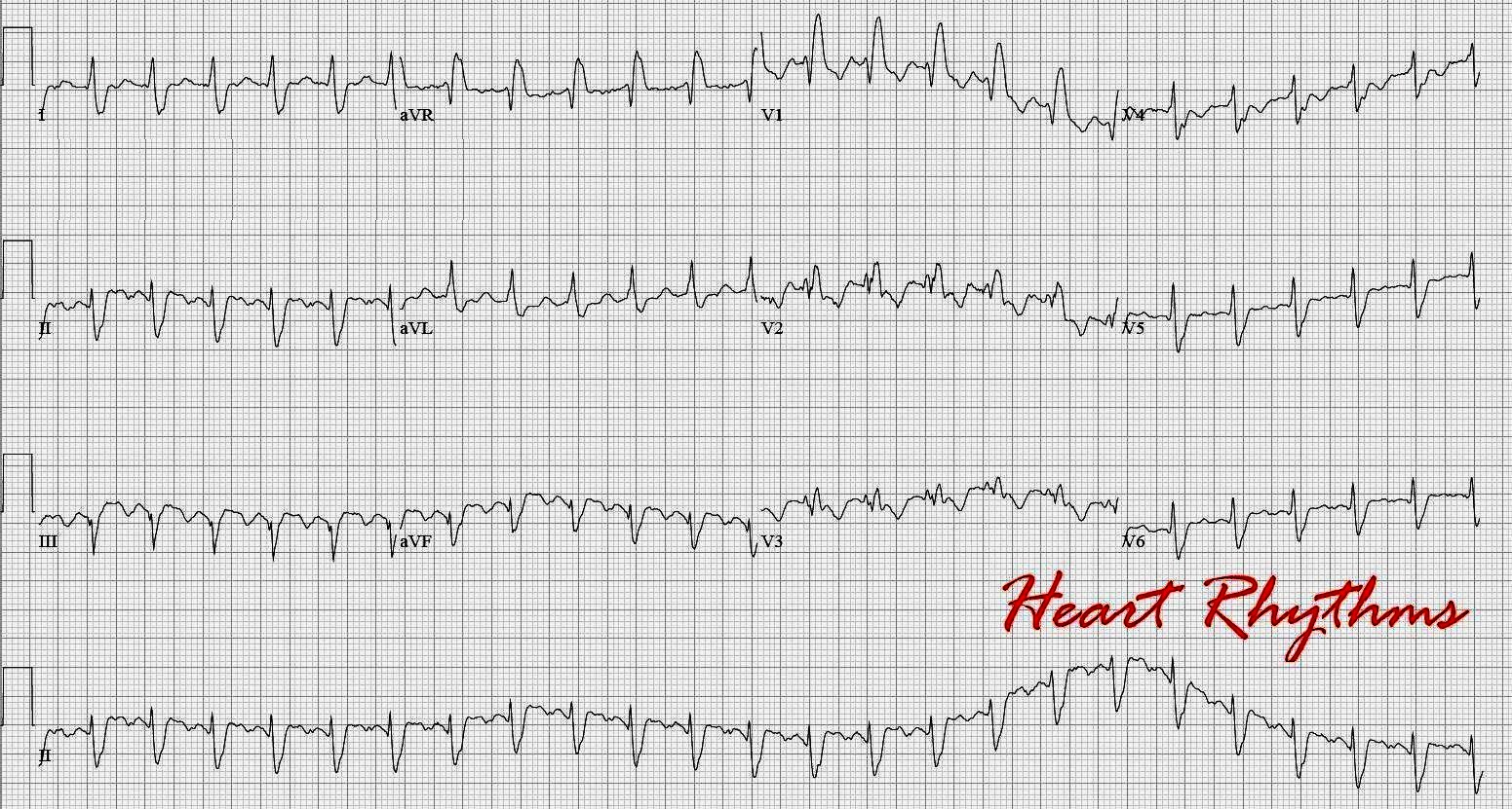 ECG Rhythms Atrial Flutter ecg-rhythms-atrial-flutter
