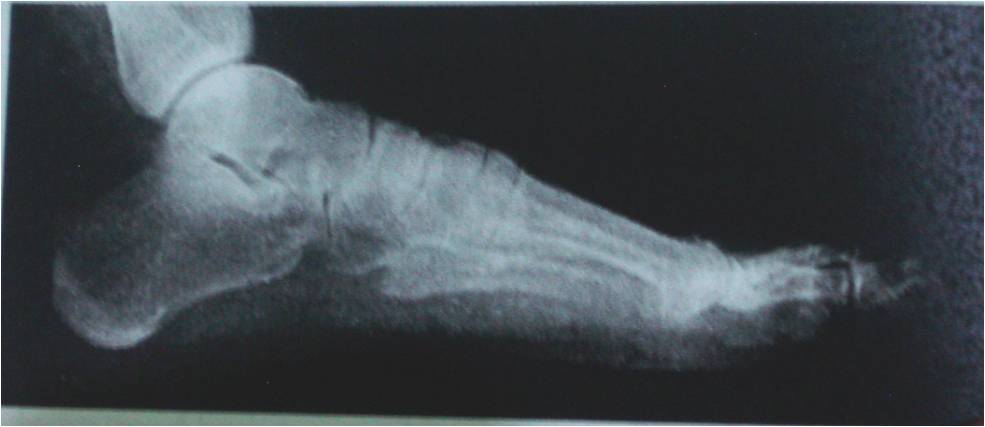 Catatan Ku: Teknik Radiografi Os Pedis