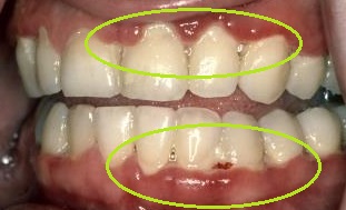 Gingivitis úlcero necrotizante aguda o GUNA