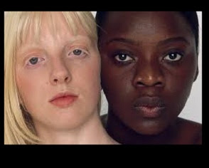 Asian skin is greatersusceptible to freckles, miasma and lent genes ...