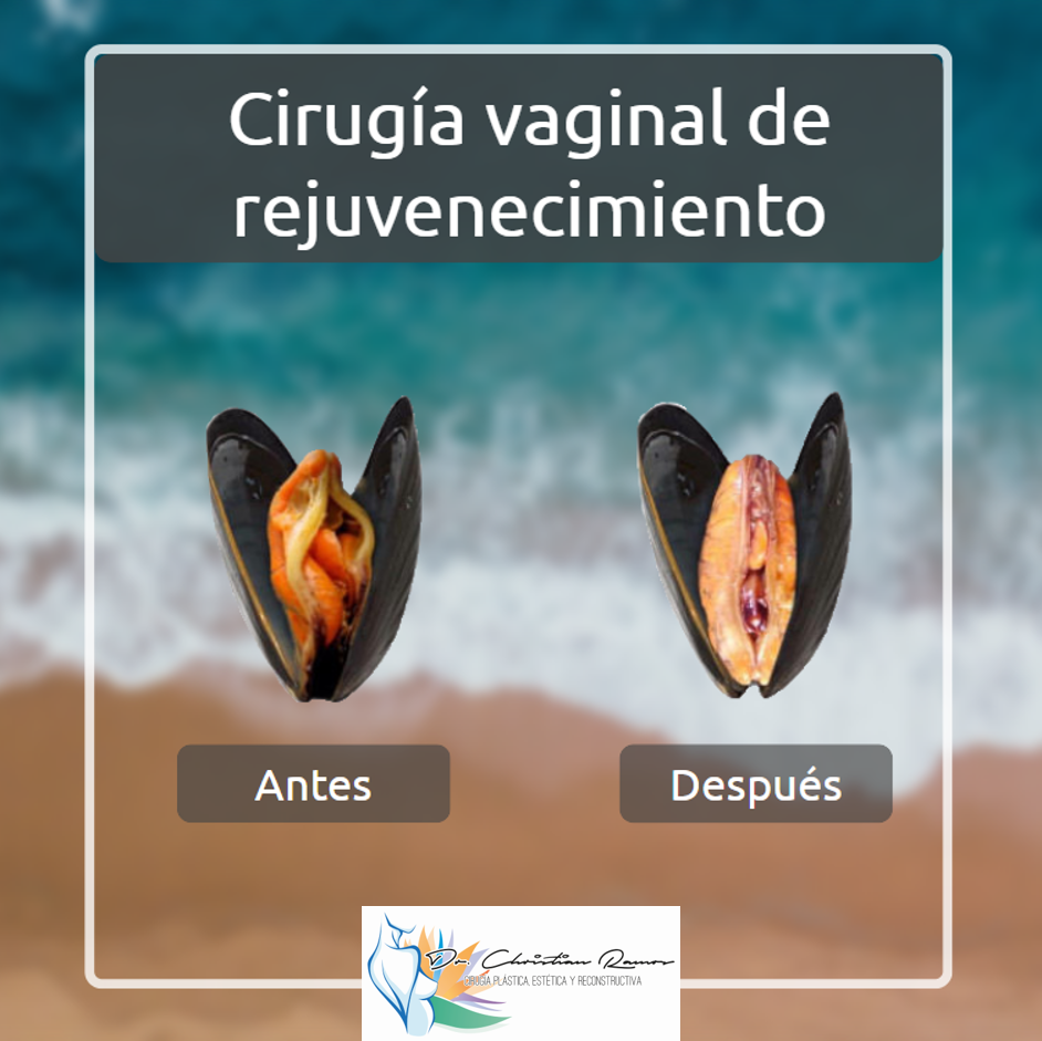 Dr. Christian Ramos: Vaginoplastía