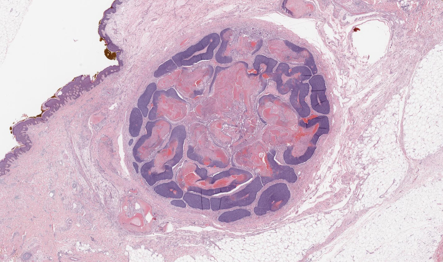 Differential Diagnosis in Dermatopathology: Pink staining