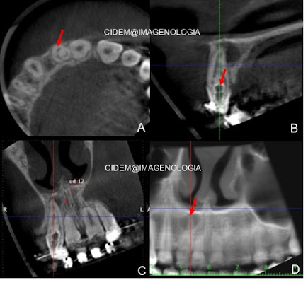 CIDEM: DENS INVAGINATUS