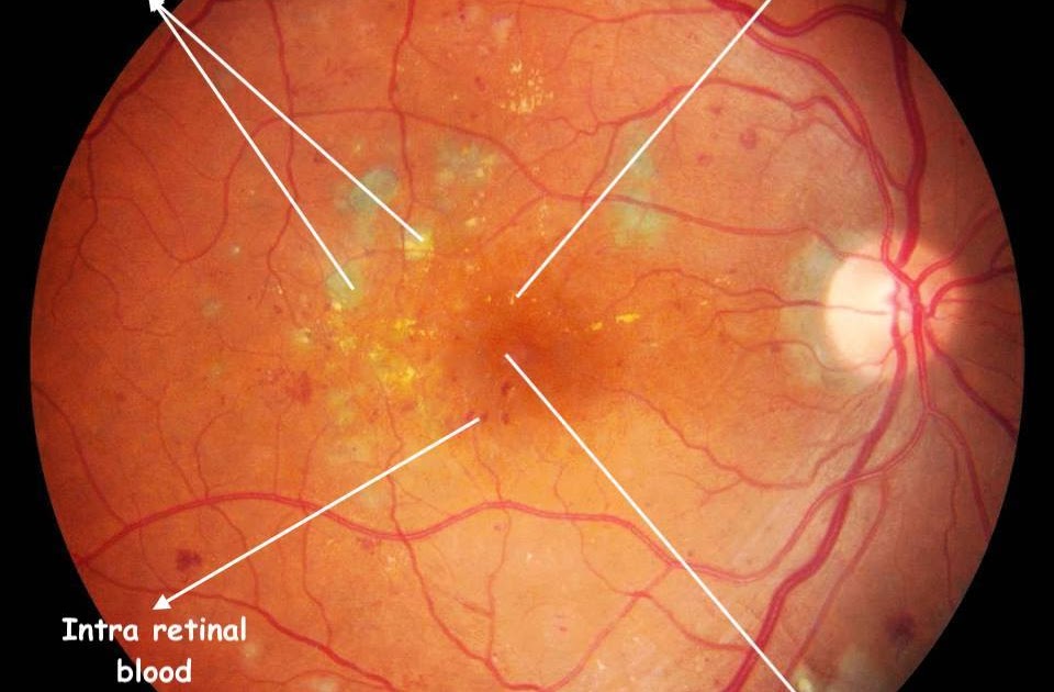 RPE atrophy post-laser treatment discussion