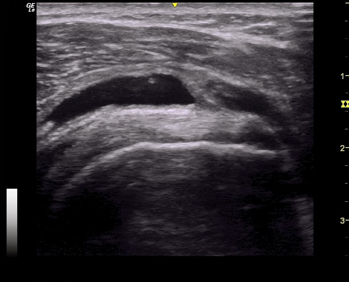 Reumails. Reumatología al día: Imagen: Rotura parcial del supraespinoso ...