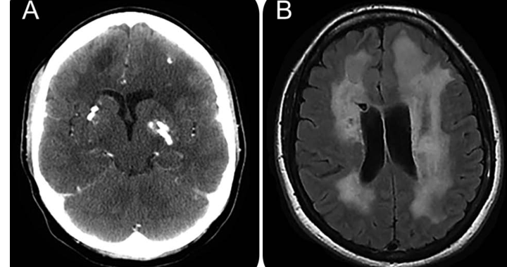 Esclerosis-Multiple-MSblog: Adult-onset leukoencephalopathy with ...