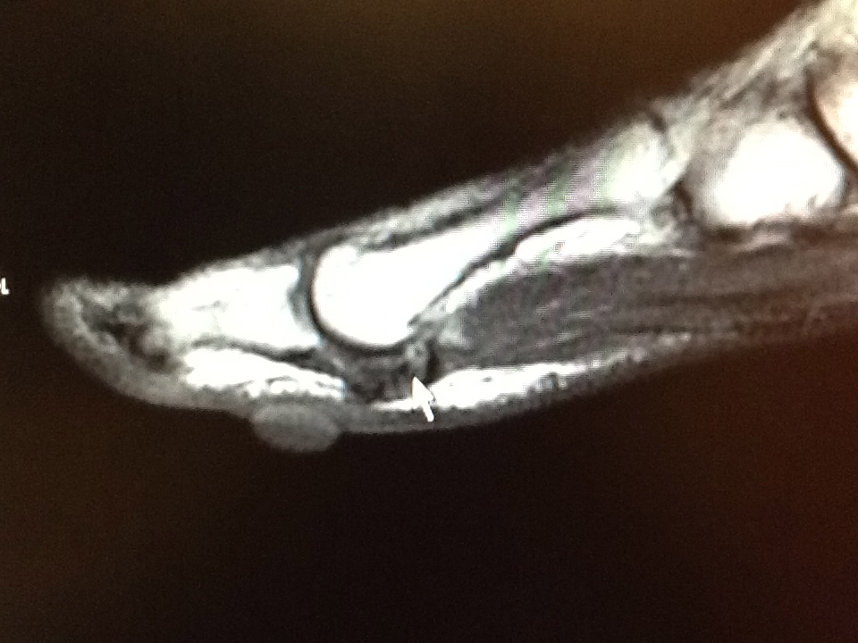Foot and Ankle Problems By Dr. Richard Blake: Sesamoid Fracture Advice ...