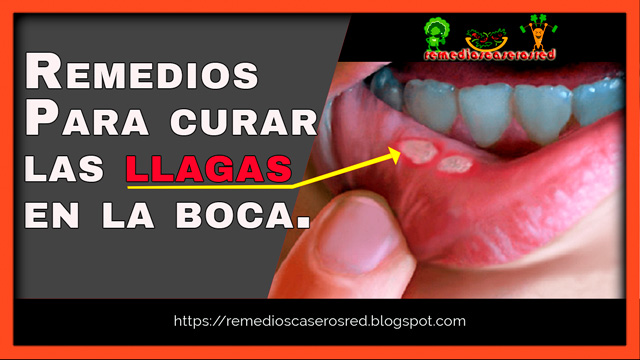 🥇 Cómo curar las llagas bucales. - remedioscaseros