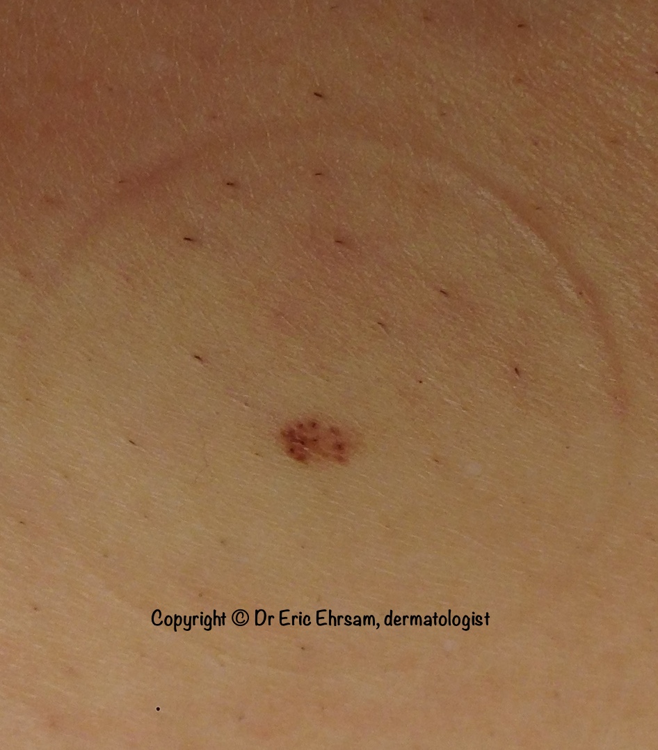 dermoscopy: A small pigmented lesion on a leg