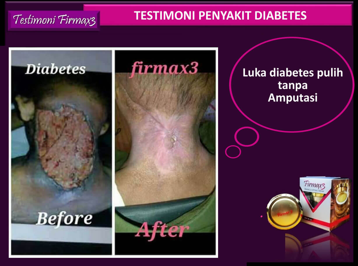 Testimoni dan Cara Pemakaian Firmax3 Untuk Diabetes