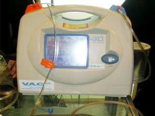 Vascular Mind : Vacuum Assisted Closure® (V.A.C. SYSTEM) for Ulcer ...