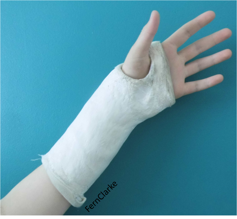 Forever Fern: CAST HACKS - I BROKE MY WRIST