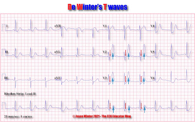 ECG Educator Blog : De Winters T waves